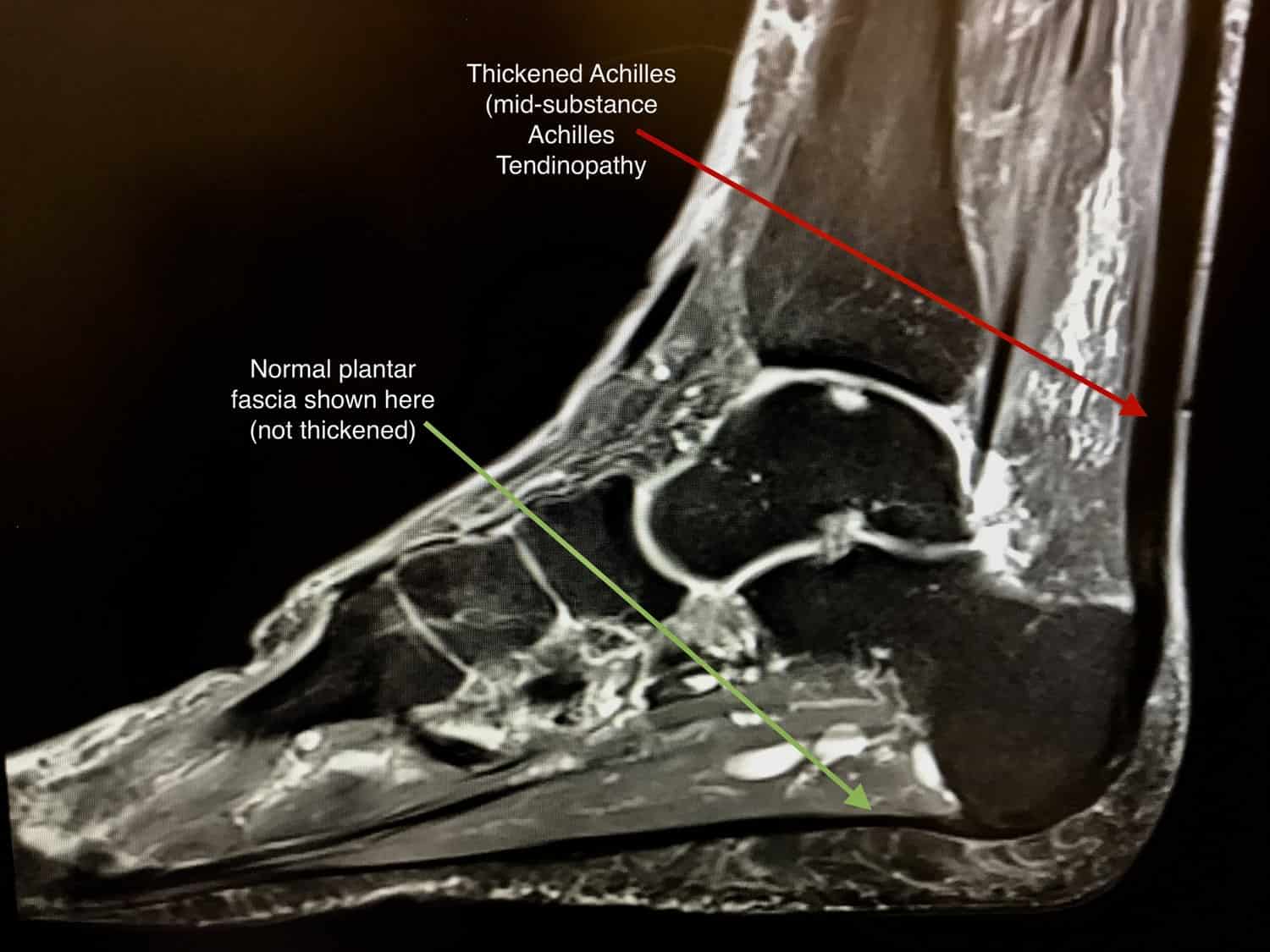 Common issues with calf muscles (read before your next leg workout) | D ...