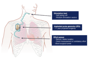 Sleep apnea: How to cure it and get your sleep back | D'Connect