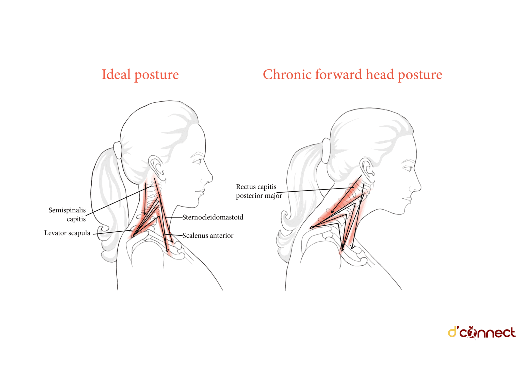 Have you got poor posture? (18 long-term effects and health risks) | D ...